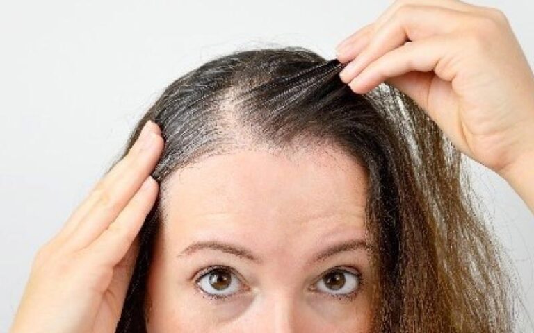 Traction Alopecia - Dr. Walia's Skin And Laser Clinic