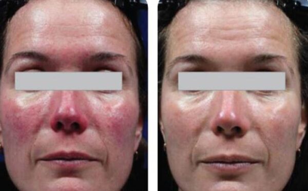 Rosacea Causes And Treatment - Dr. Walia's Skin And Laser Clinic