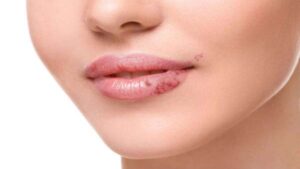 Fordyce Spots - Dr. Walia's Skin And Laser Clinic